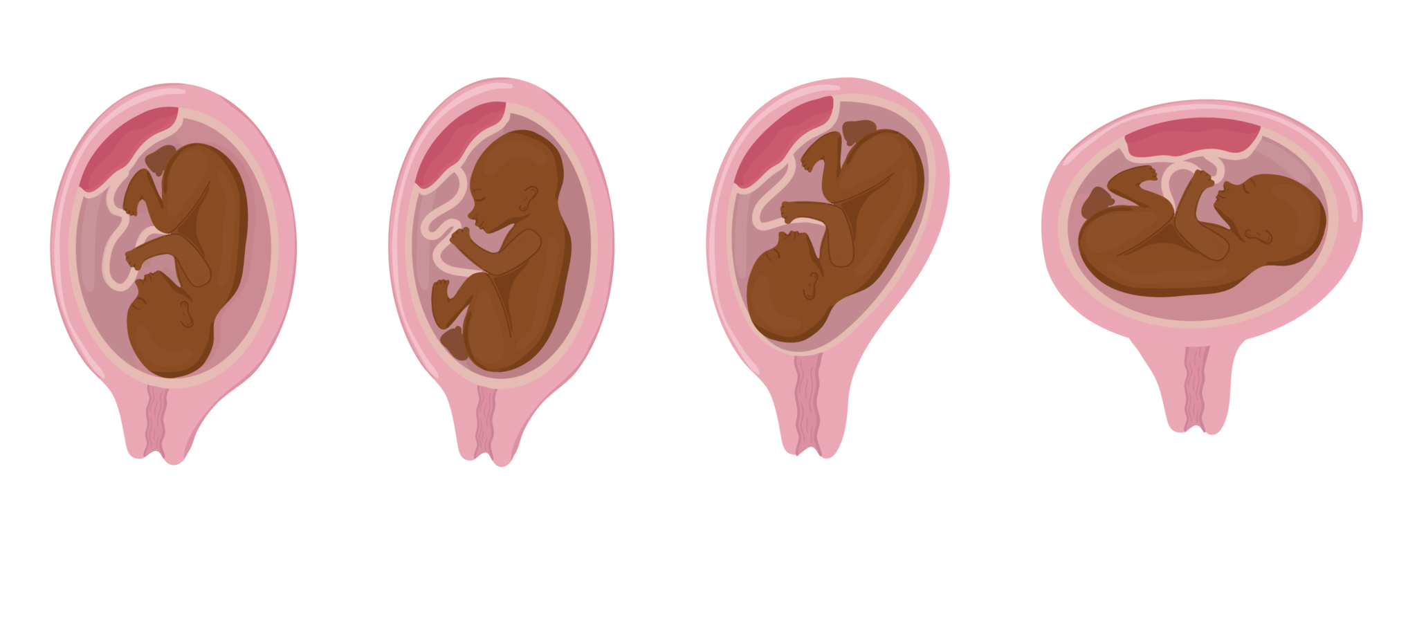 Breech Pregnancy: What It Is and How You Can Help Your Baby Turn Around ...